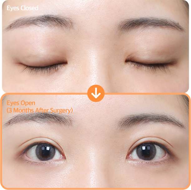 Eye Revision Surgery - Lamiche Plastic Surgery