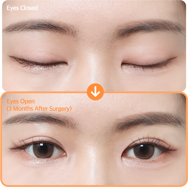 Eye Revision Surgery - Lamiche Plastic Surgery