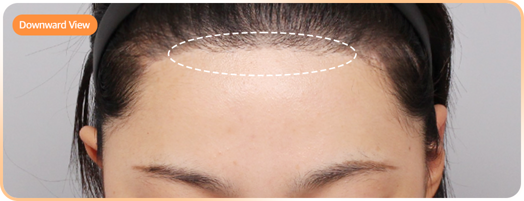 Forehead Augmentation - Lami Plastic Surgery